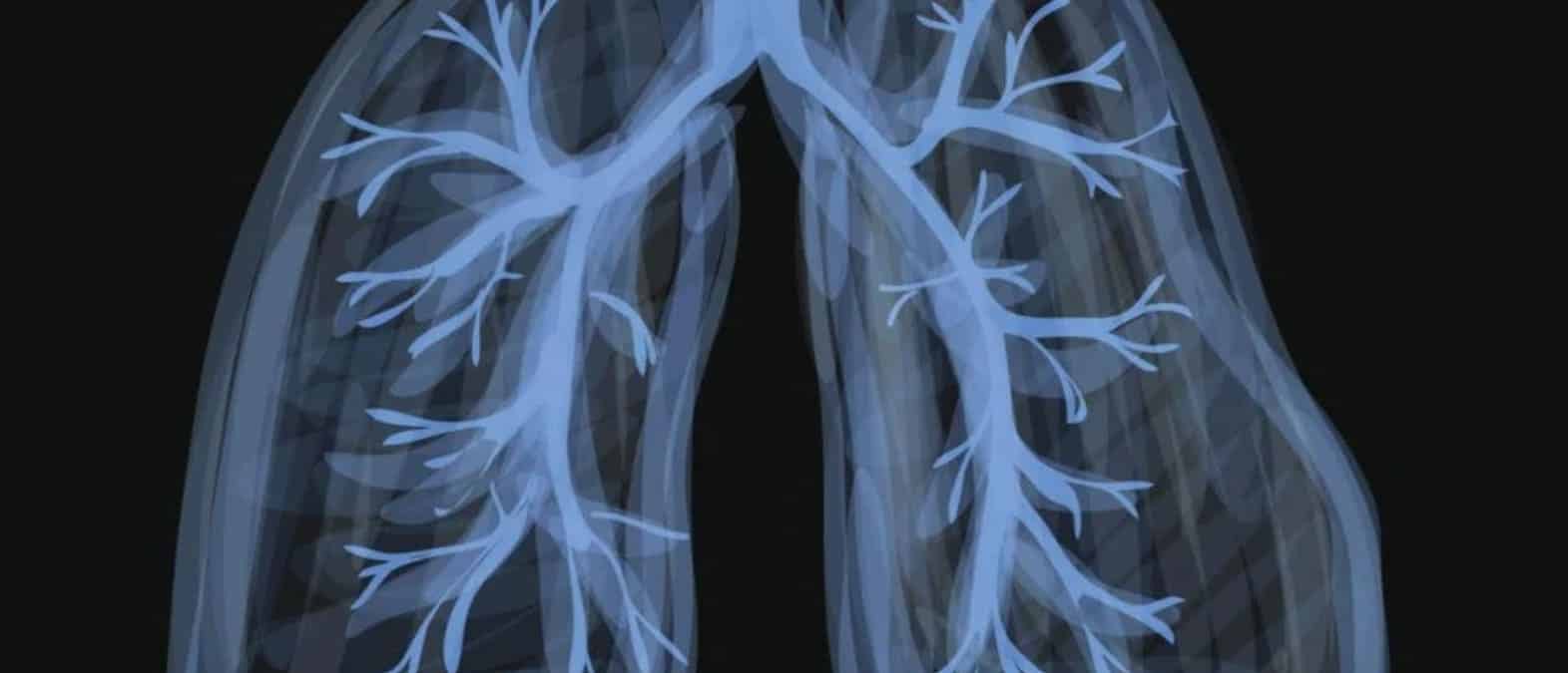 Tout sur la Bronchite Asthmatique : Causes, Symptômes et Soins ...
